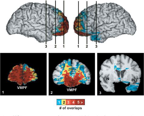 Ventromedial Prefrontal Cortex Semantic Scholar