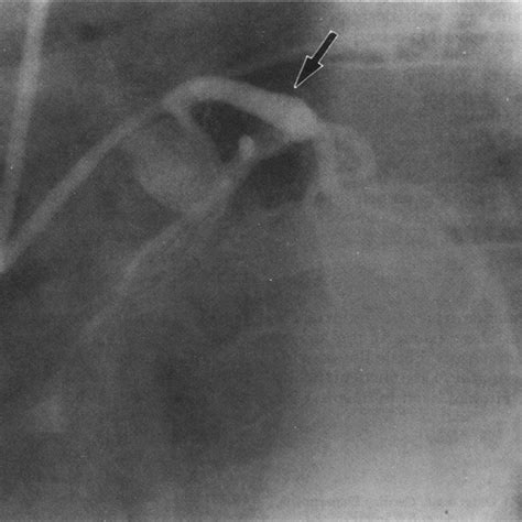 Selective Contrast Injection Of The Left Coronary Artery Via A Brachial