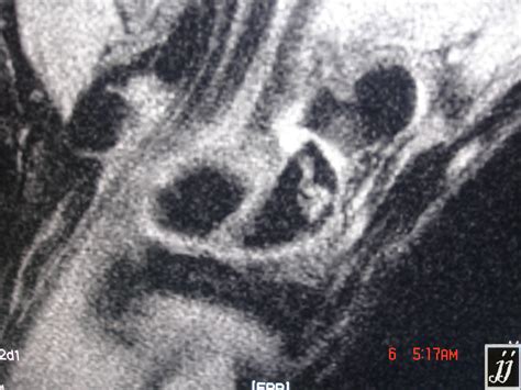 Scaphoid Cyst Radiopaedia