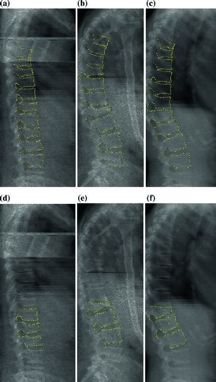 Of Vertebrae On Dxa Images Using Constrained Local Models With Random