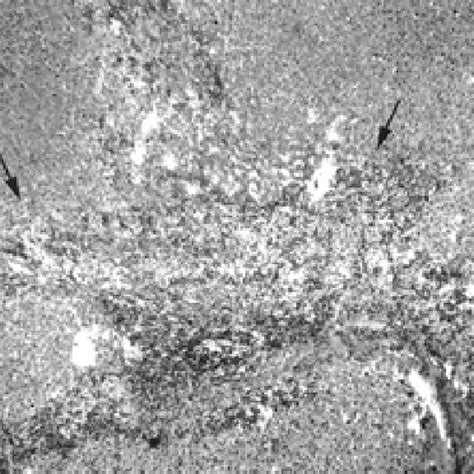 Pathology Of Focal Nodular Hyperplasia In 27 Year Old Women Gross