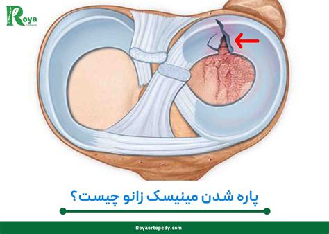 تشخیص و درمان پارگی مینیسک زانو بدون جراحی رویا ارتوپدی