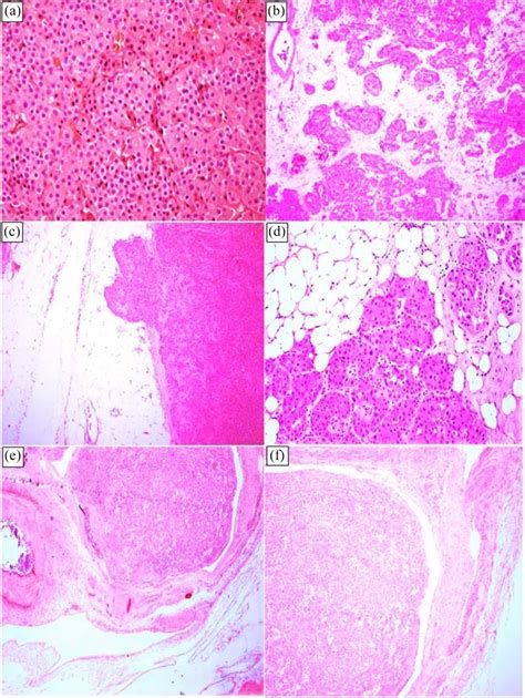 A Oncocytoma With A Solid Growth Pattern And Composed Of Polygonal Download Scientific