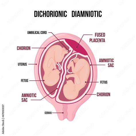 Dichorionic Diamniotic Twins With Fused Placenta Stock Vector Adobe Stock
