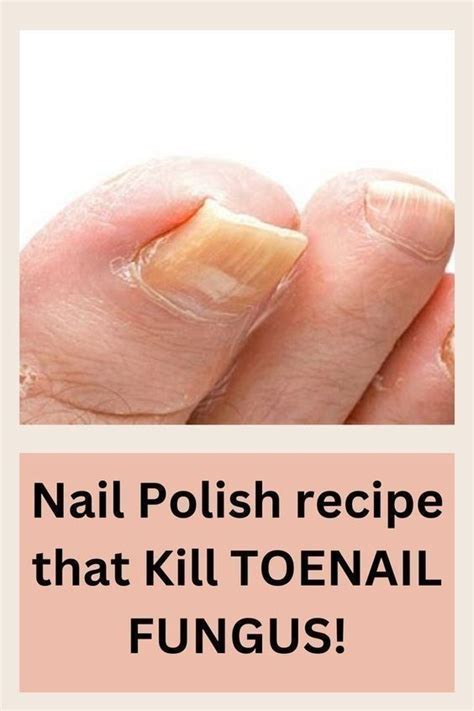 The 10 Best Home Remedies For Toenail Fungus Artofit
