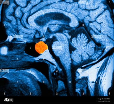 Brain Tumour Coloured Computed Tomography Ct Scan This Is A Side