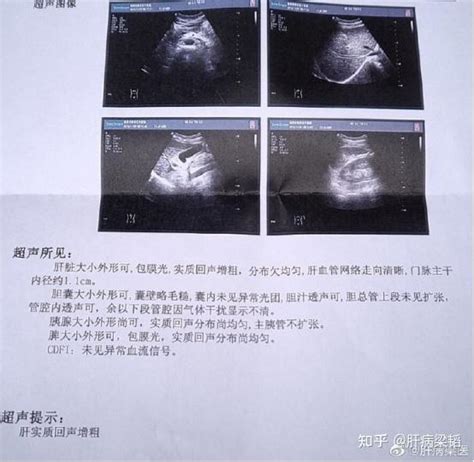 有乙肝，需要警惕肝脏彩超回声增粗 知乎