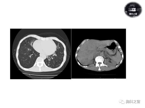 Aids合并马尔尼菲篮状菌病真菌
