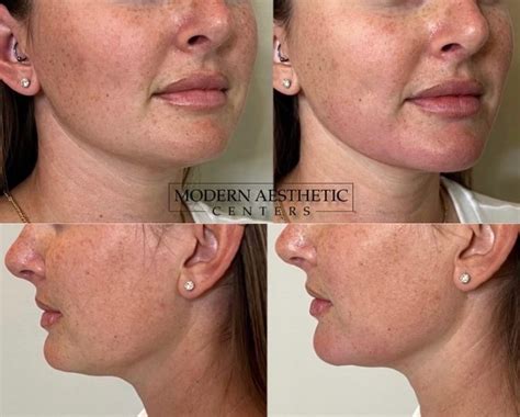 Before And After Dermal Fillers Procedures In St Johns Fl Modern