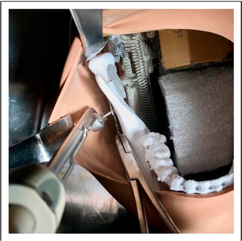 Figure 2 From Simulating A Subcondylar Mandibular Fracture With