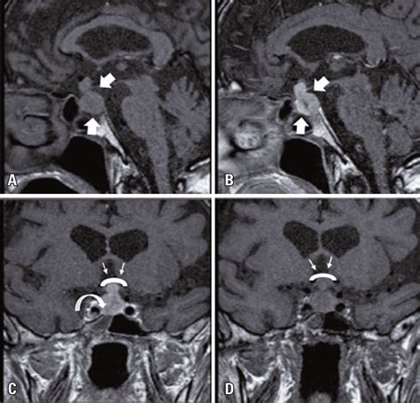 Metastatic Diffuse Follicular Variant Papillary Thyroid Cancer Without Cervical Lymph Node