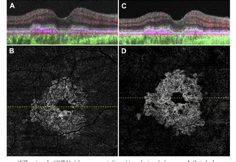 Figure 4 From Natural History Of Subclinical Neovascularization In Nonexudative Age Related