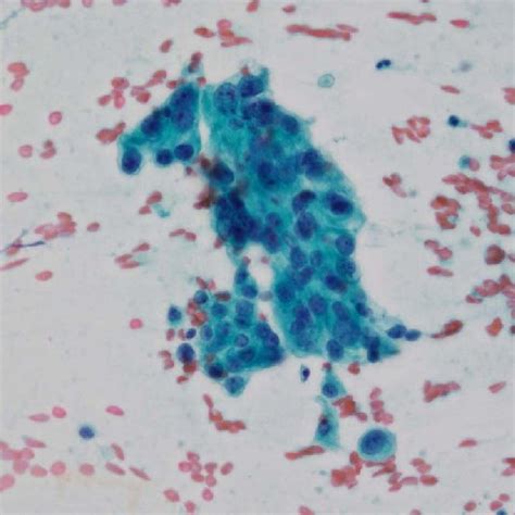Peritoneal Lavage Cytology Was Suggestive Of Adenocarcinoma The Sheet