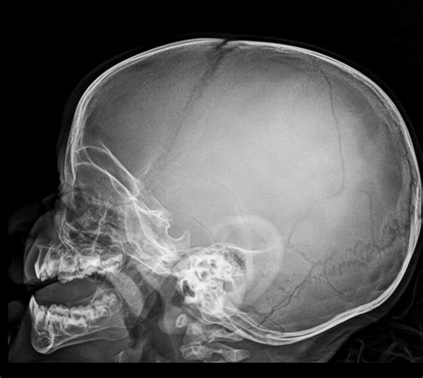 skull fractures neuropedia