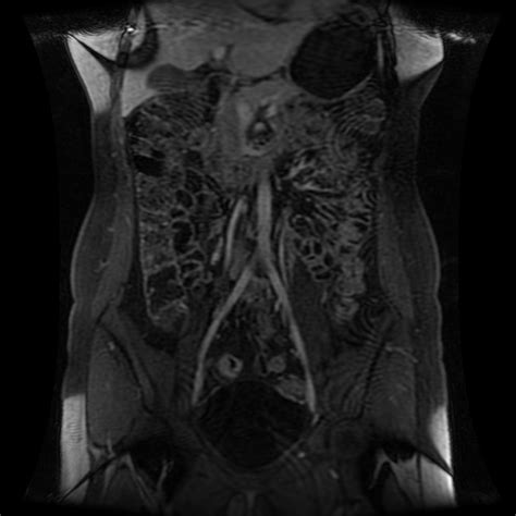 Mr Enterography Evaluation Of Crohns Disease Terminal Ileitis Image