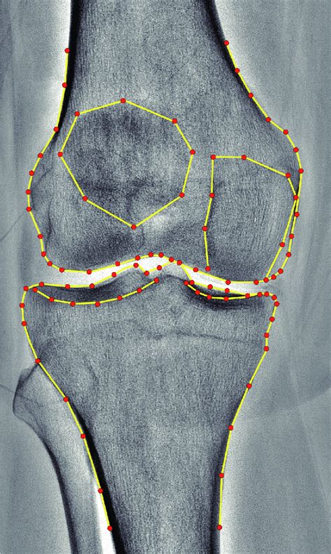 Statistical Shape Model Knee Definition Of The Statistical Shape Download Scientific Diagram