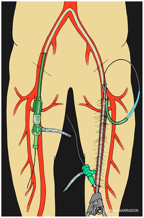 Diagram Of Total Percutaneous Bypass Showing Stiff Wire From The Long Download Scientific