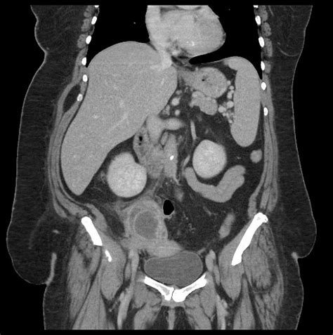 Journal Of Brown Hospital Medicine On Twitter 60yo F With
