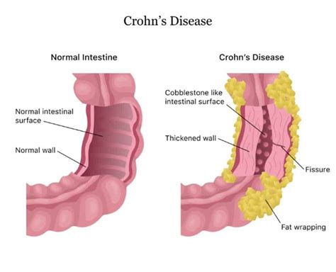 Comprendre La Maladie De Crohn Un Facteur De Risque Pour Le Cancer Colorectal Colorectal