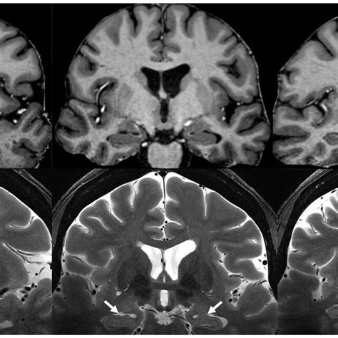Axial Plane Tof Mra Mip Left And Swi Minip Right Mr Images Note