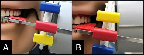 Problem 4 Bitewing Images Not Ideal Intraoral Imaging Techniques