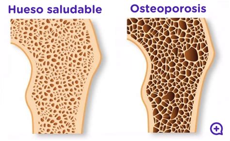 Osteoporosis Causas Y Tratamientos MediQuo