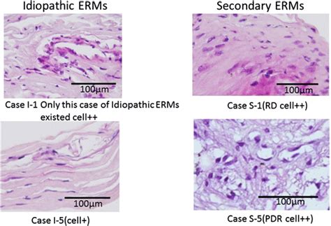 Epiretinal Membranes Erms Stained With He Idiopathic Erms Top Left