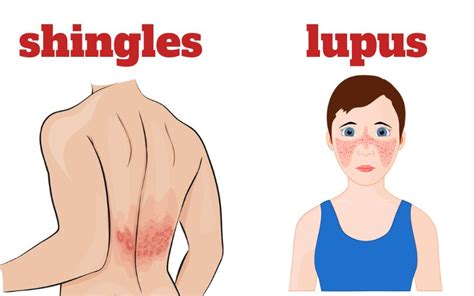 What Is The Difference Between Shingles And Lupus Lupusca