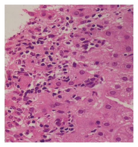 A Foci Of Confluent Necrosis Infiltrated By Inflammatory Cells H