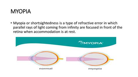 Myopia And Hypermetropia Pptx