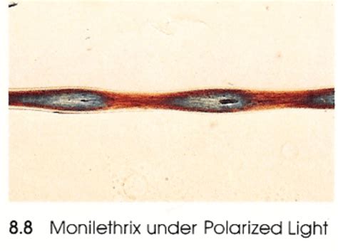 Hair Disorders Monilethrix