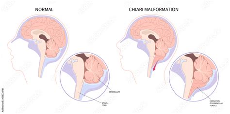 Anatomy Of Brain Cancer Tumor Bleeding With Chiari Malformation Stock Vector Adobe Stock