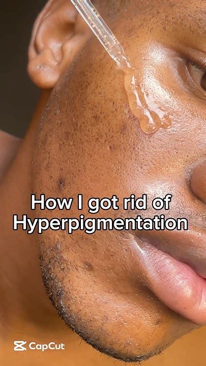 How I Got Rid Of My Hyperpigmentation Hyperpigmentation Enlargedpores Aestheticdermatology How I Got Rid Of My Hyperpigmentation Hyperpigmentation Enlargedpores Aestheticdermatology