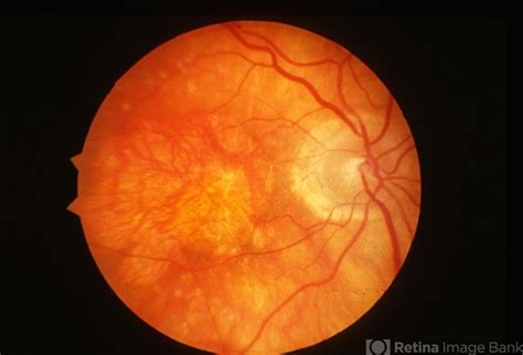 Central Areolar Choroidal Sclerosis Retina Image Bank