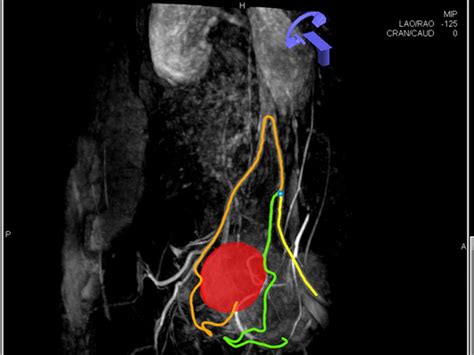 Syngo Embolization Guidance Siemens Healthineers