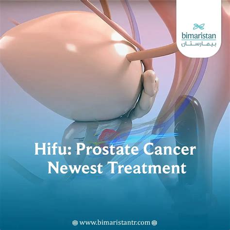 Hifu Treatment For Prostate Cancer In Turkey 2025