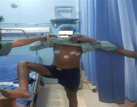 Left Thorascopic Sympathectomy Download Scientific Diagram