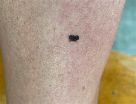 Does This Look Like Melanoma Rmelanoma