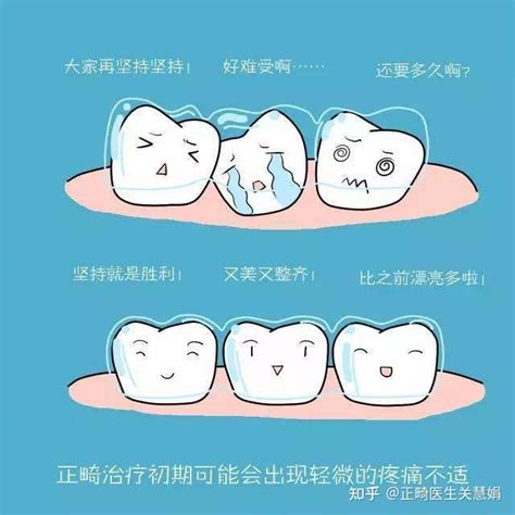 隐形牙套佩戴感受早知道 知乎