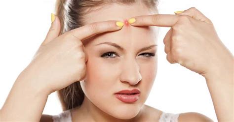 An Easy Guide On How To Get Rid Of A Pimple Overnight