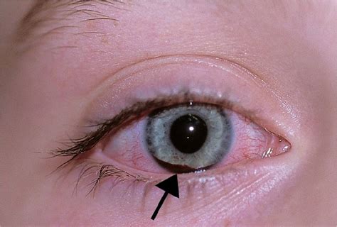 Pupil Iris And Lens Abnormalities Visual Diagnosis And Treatment In Pediatrics 3 Ed