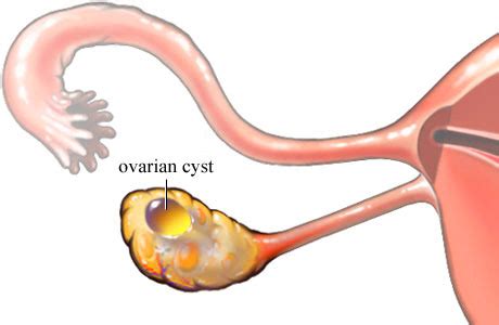 Is A Dermoid Cyst A Functional Cyst