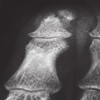 Various Fixation Methods Of Metacarpal Fractures Metacarpal Base Download Scientific Diagram