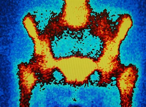 Nuclear Medicine Pelvic Scan Stock Image Image Of Bones Nuclear