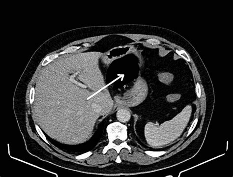 Intestinal Loops Arrow Displacing The Stomach To The Left Download Scientific Diagram