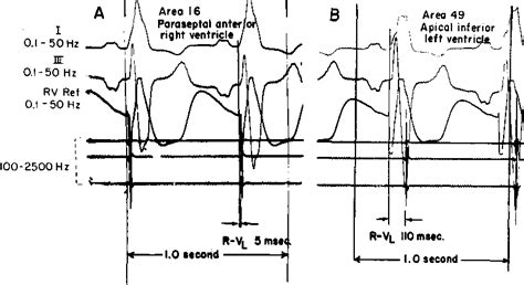 Left Bundle Branch Block Semantic Scholar