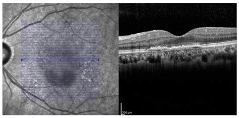 The Volumetric Scans Of Spectralis Sd Oct A Custom 20° × 20° Volume Download Scientific