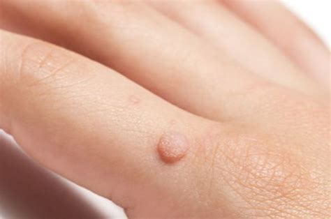 4 Jenis Kutil Yang Harus Diketahui Ternyata Ini Penyebab Munculnya