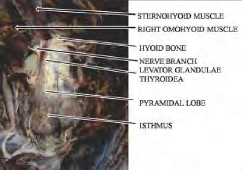 Muscular Levator Glandulae Thyroidea Lgt Situated On The Right Side Download Scientific