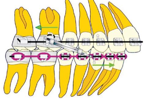 Six Keys To Early Mixed Dentition Class Ii Correction A Quantified